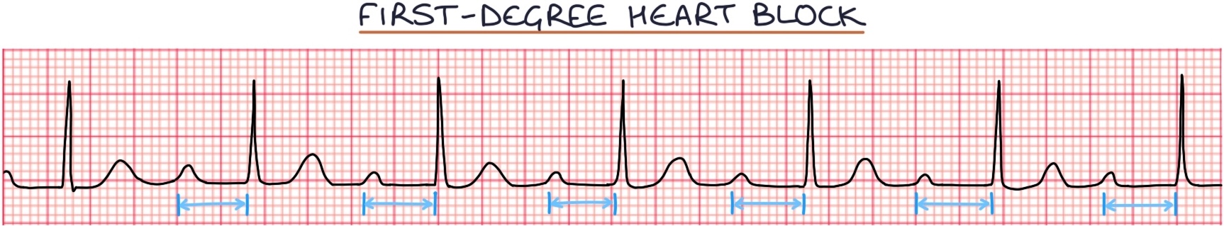Arrhythmias – Zero To Finals
