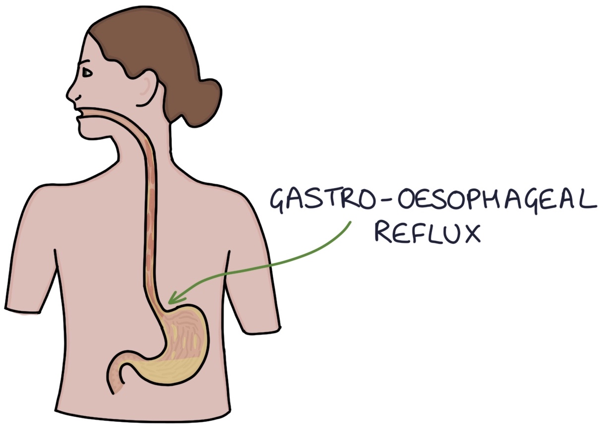 Gastro-Oesophageal Reflux Disease – Zero To Finals