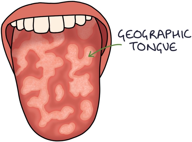 Tongue Conditions – Zero To Finals