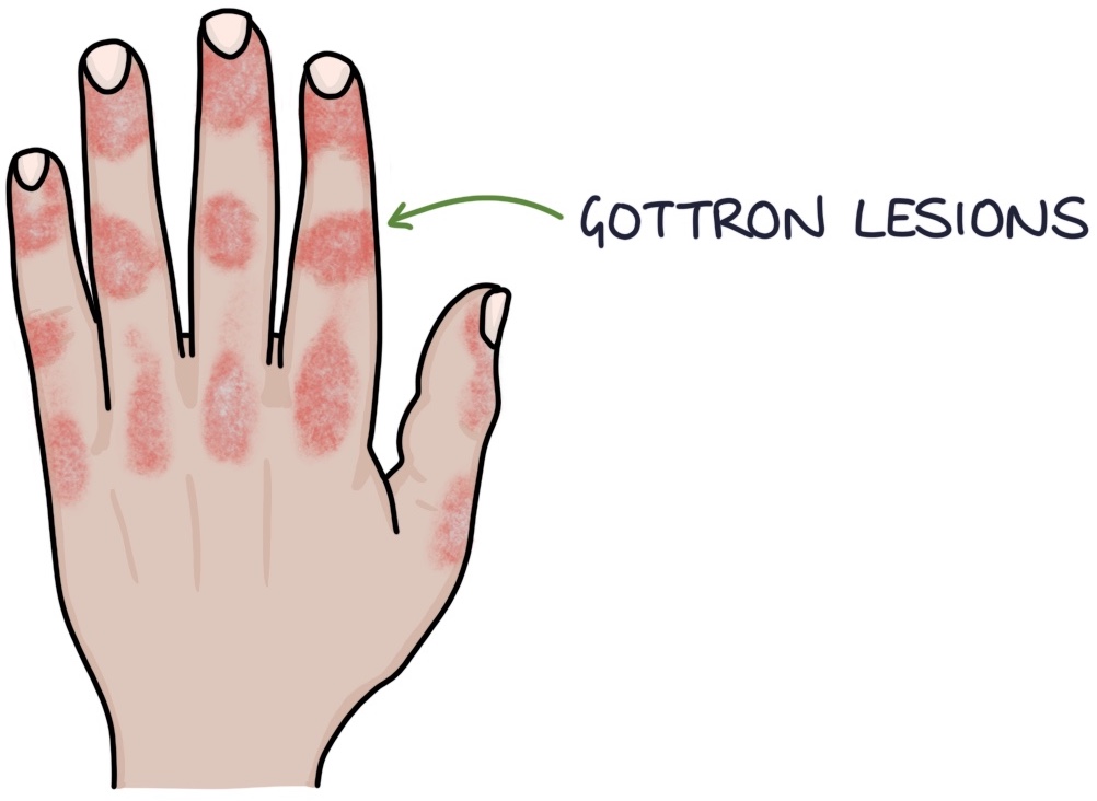 Polymyositis and Dermatomyositis – Zero To Finals