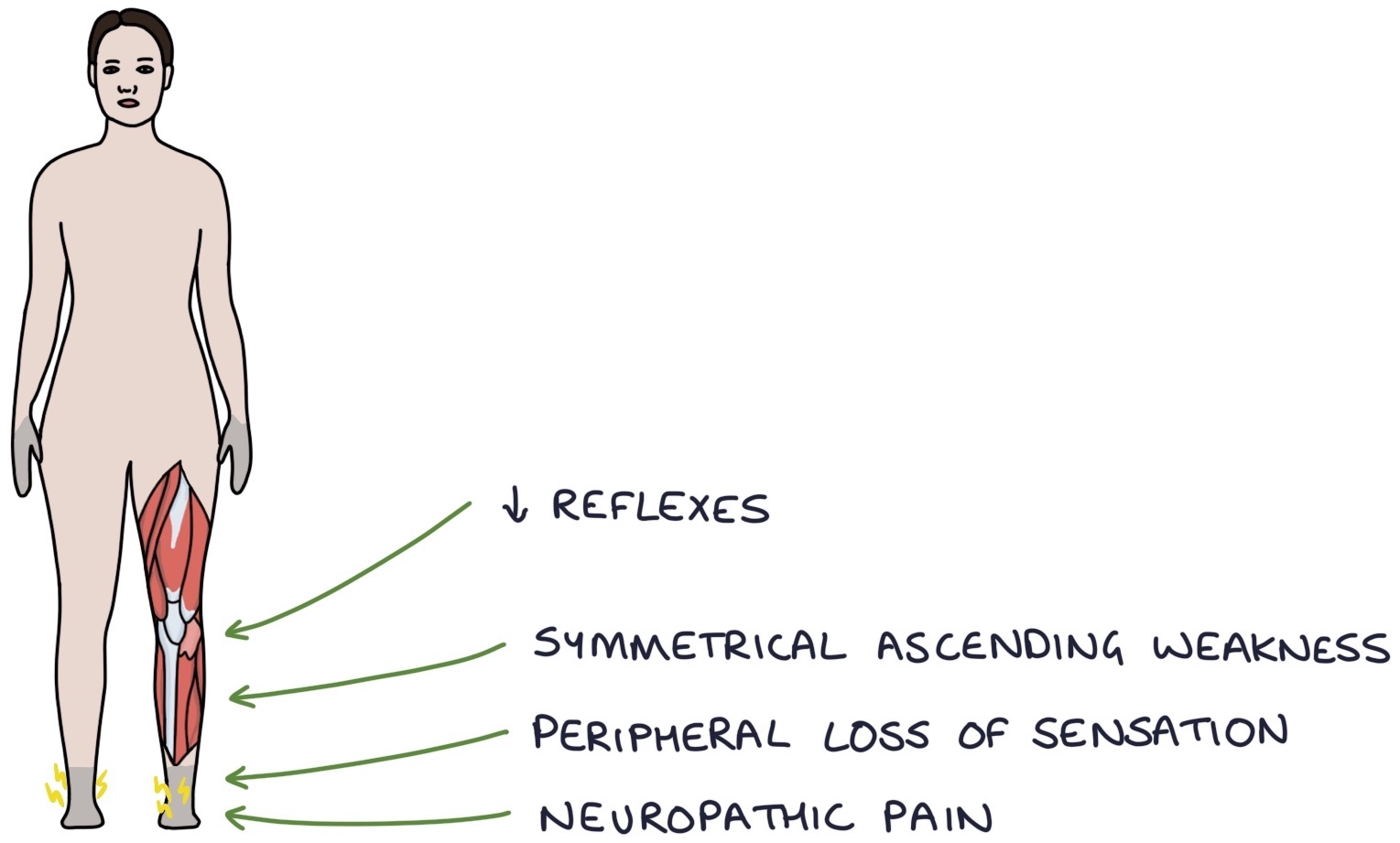 Guillain-Barré Syndrome – Zero To Finals