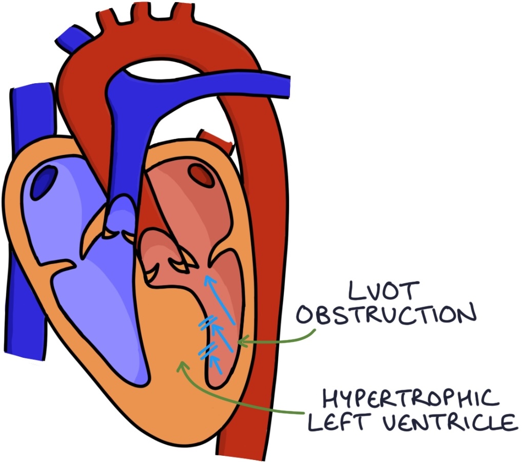 Hypertrophic Obstructive Cardiomyopathy – Zero To Finals