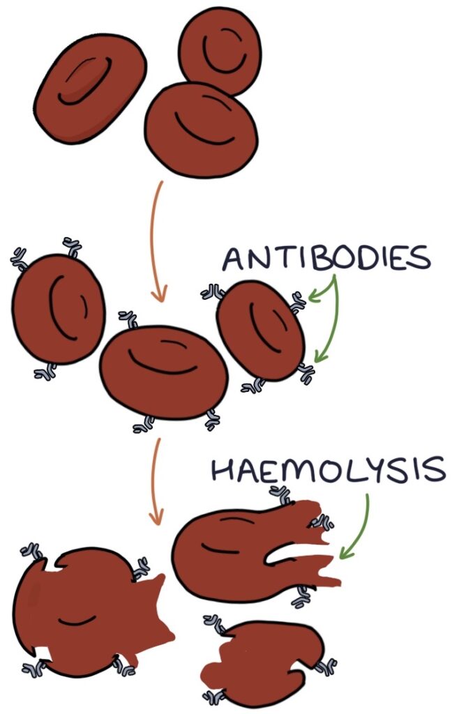 Haemolytic Anaemia – Zero To Finals