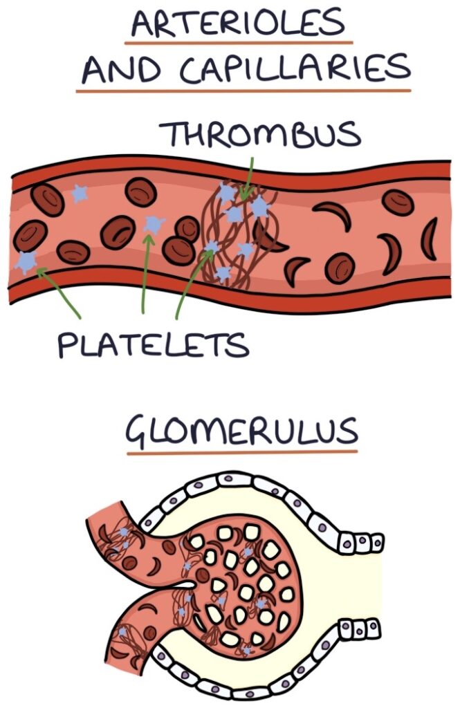 Haemolytic Uraemic Syndrome – Zero To Finals