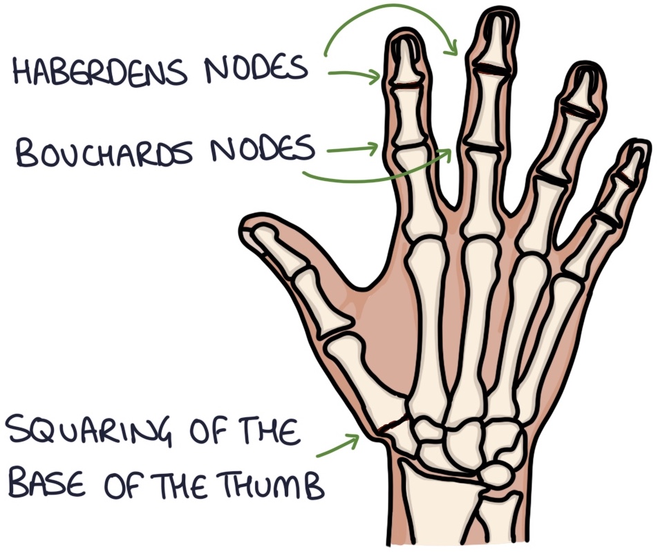 Osteoarthritis – Zero To Finals