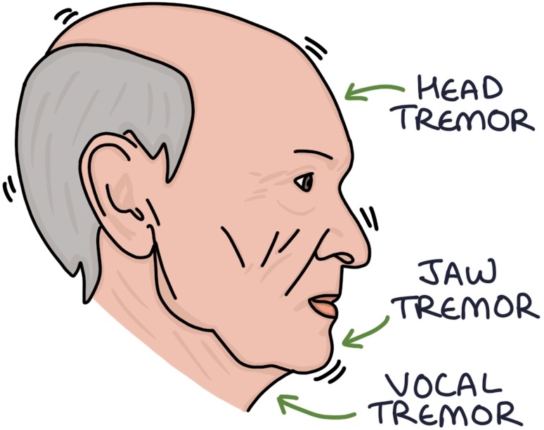 Benign Essential Tremor – Zero To Finals