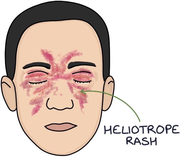 Polymyositis and Dermatomyositis – Zero To Finals