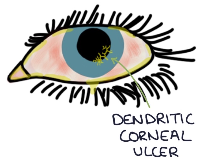 Herpes Keratitis – Zero To Finals
