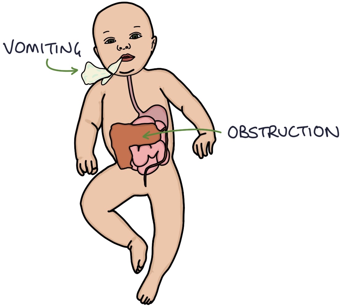Hirschsprung’s Disease – Zero To Finals