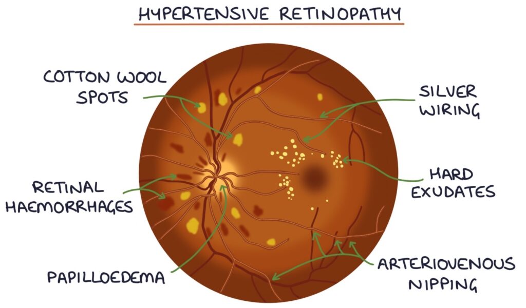 Hypertensive Retinopathy – Zero To Finals