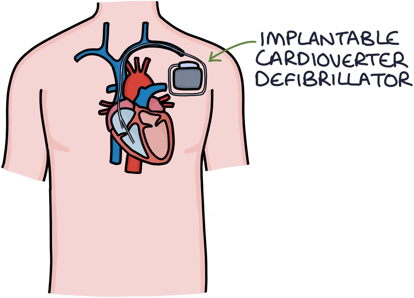Arrhythmias – Zero To Finals