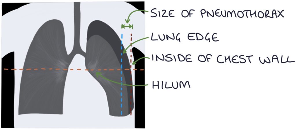 Pneumothorax – Zero To Finals