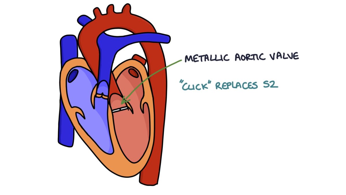 Prosthetic Heart Valves – Zero To Finals