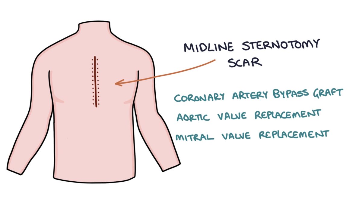 Prosthetic Heart Valves – Zero To Finals