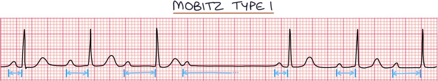 Arrhythmias – Zero To Finals