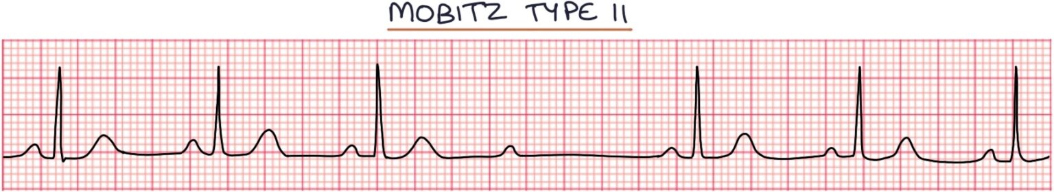 Arrhythmias – Zero To Finals