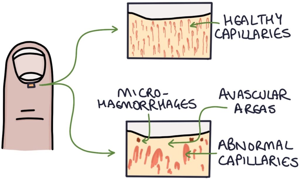 Systemic Sclerosis – Zero To Finals