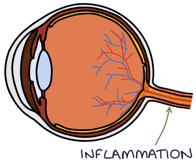 Multiple Sclerosis – Zero To Finals