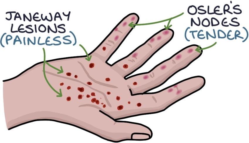 Infective Endocarditis – Zero To Finals