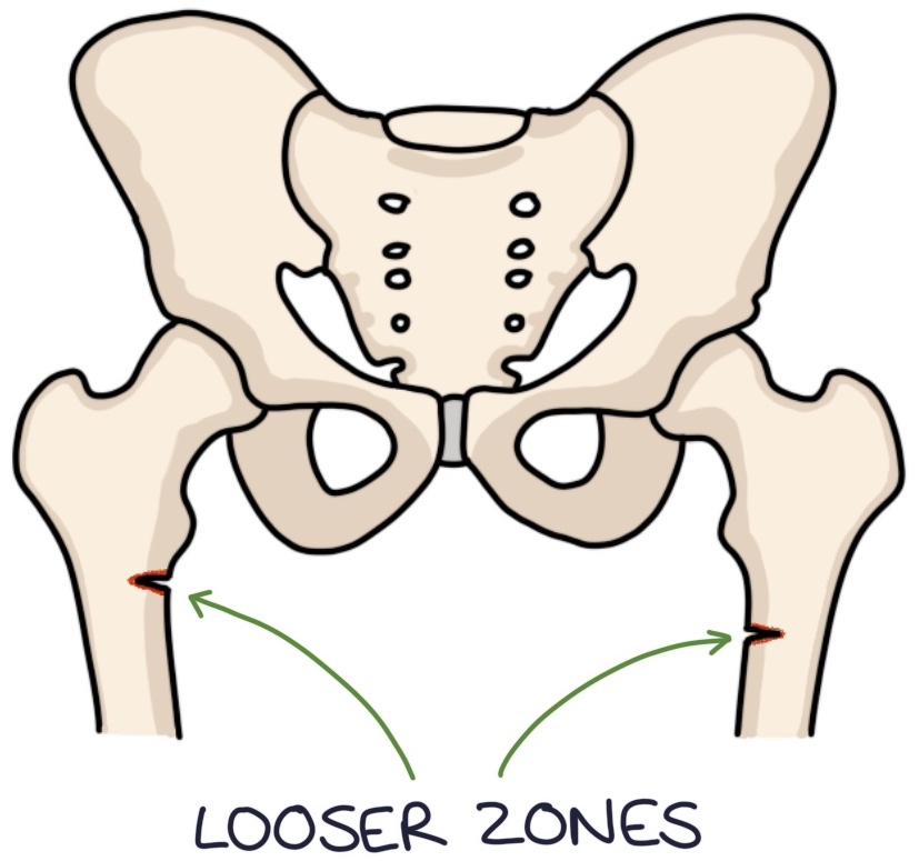 Osteomalacia – Zero To Finals
