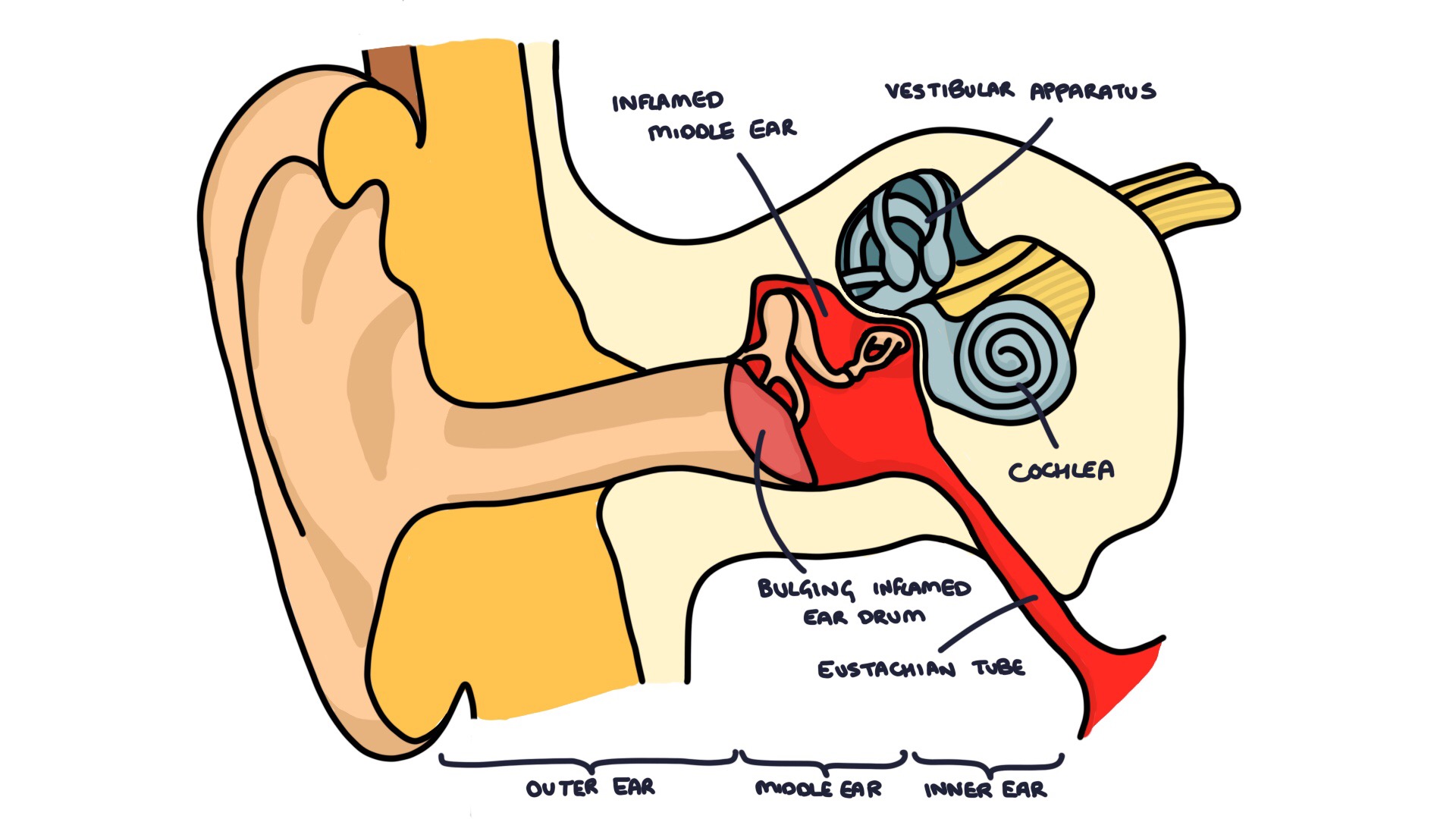 Otitis Media – Zero To Finals