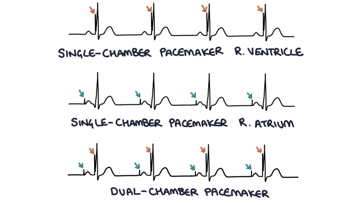 Pacemakers – Zero To Finals