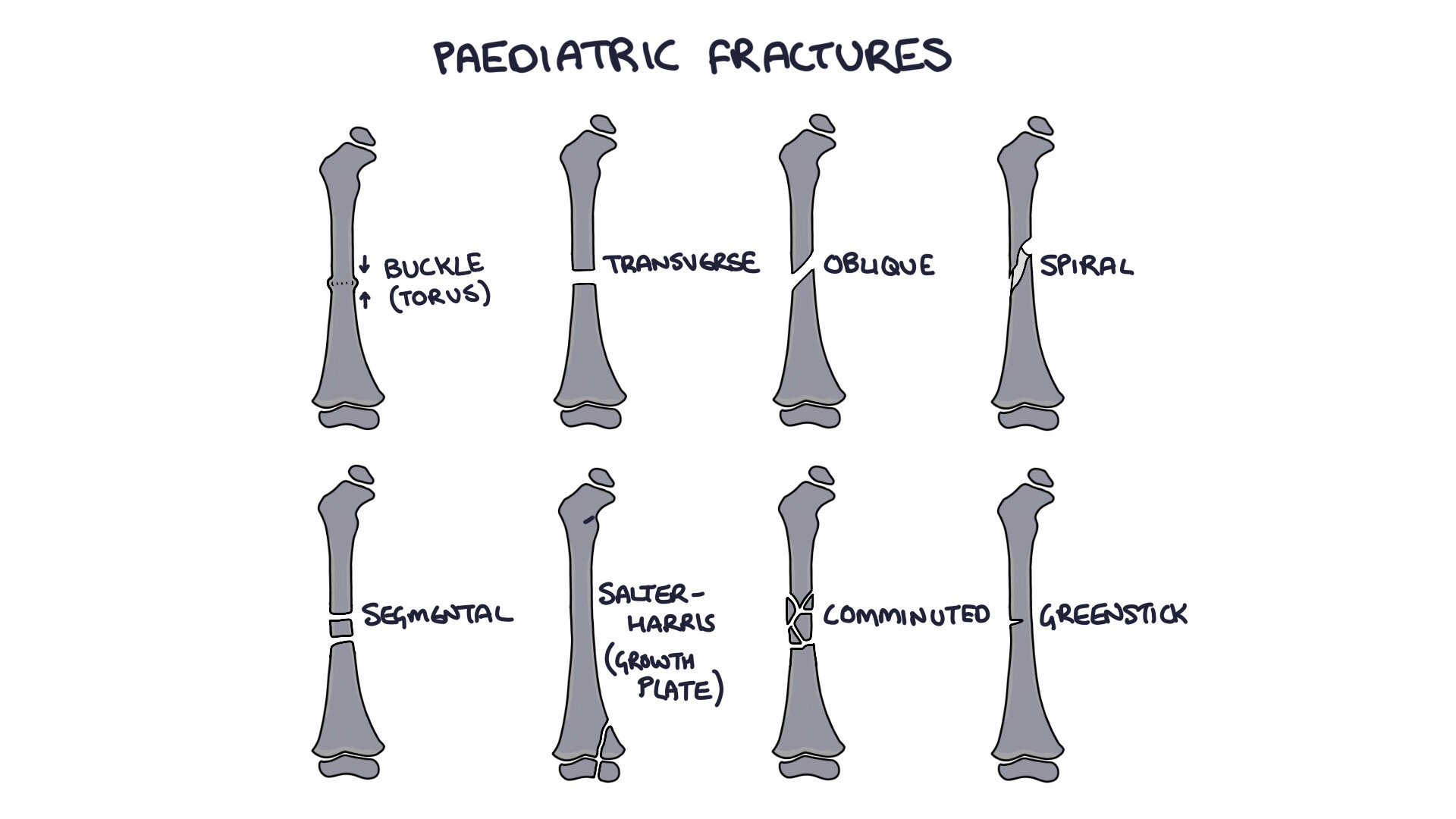 Fracture modeling