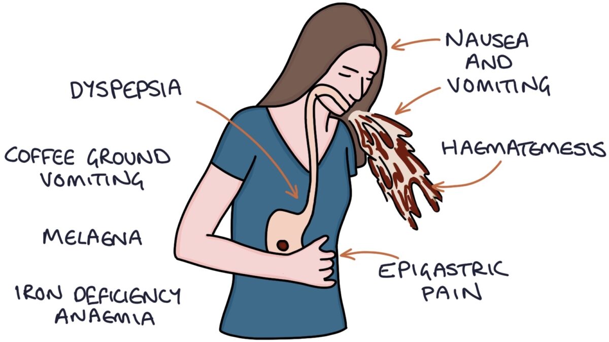 Peptic Ulcers – Zero To Finals