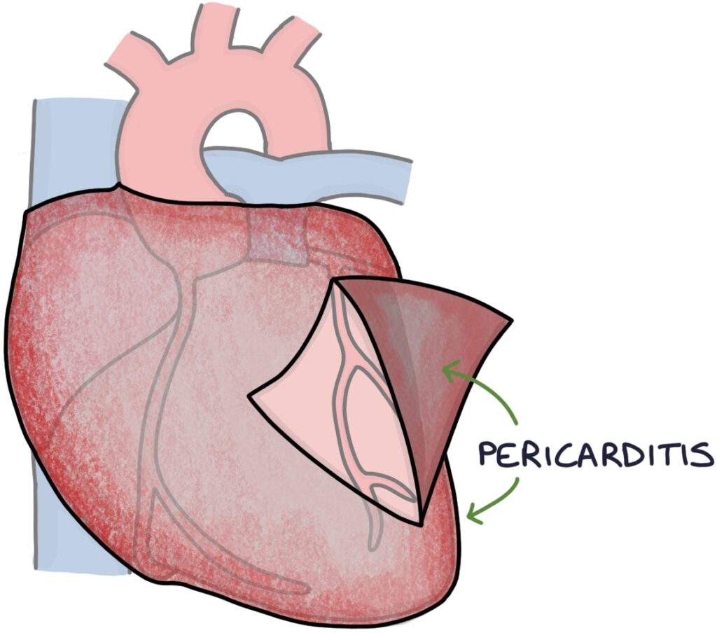 Pericarditis – Zero To Finals