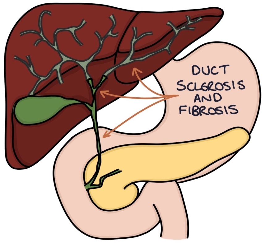 Primary Sclerosing Cholangitis – Zero To Finals