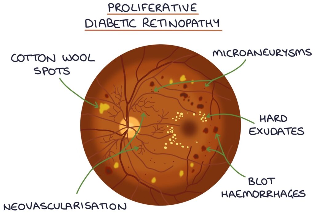 Diabetic Retinopathy – Zero To Finals