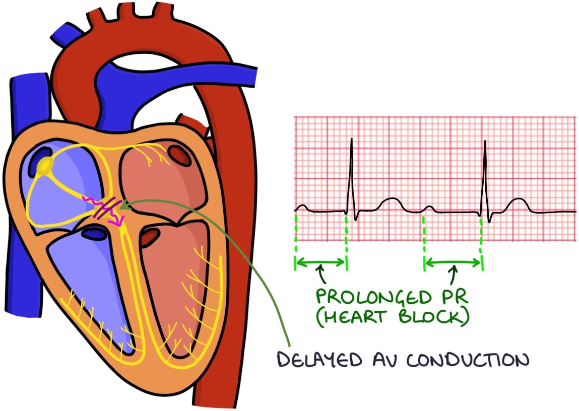ECG Basics and Sinus Rhythm – Zero To Finals