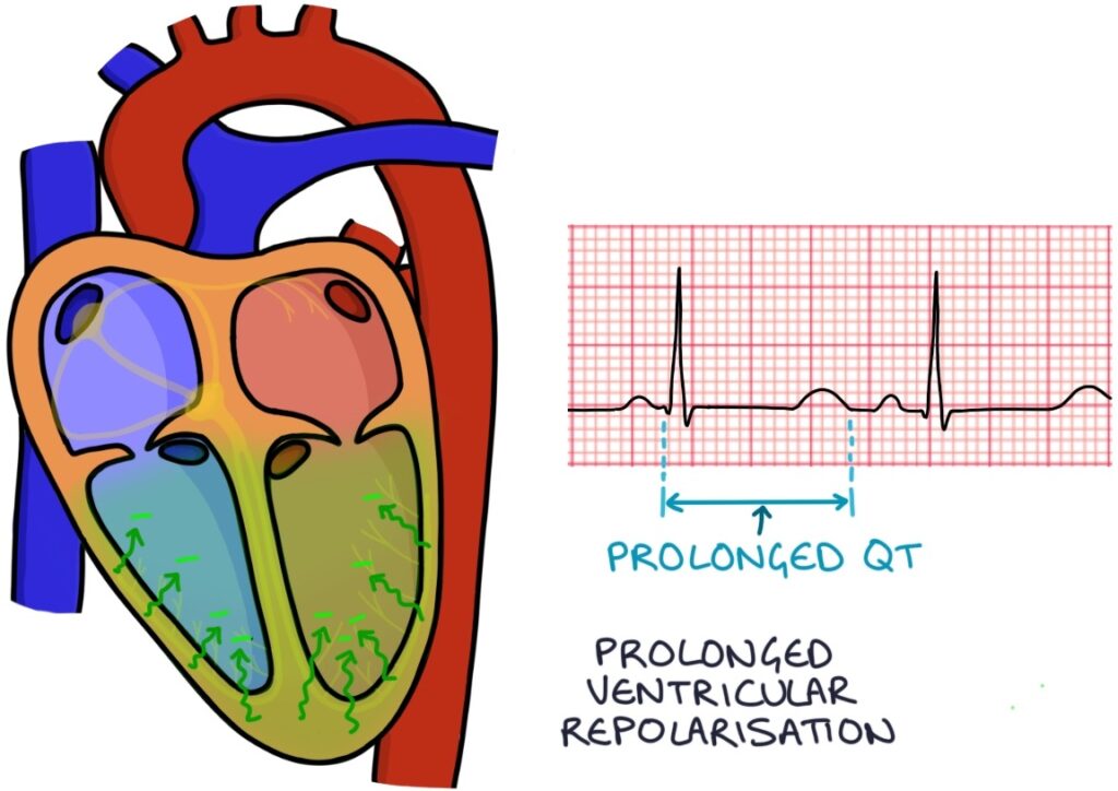 ECG Basics and Sinus Rhythm – Zero To Finals