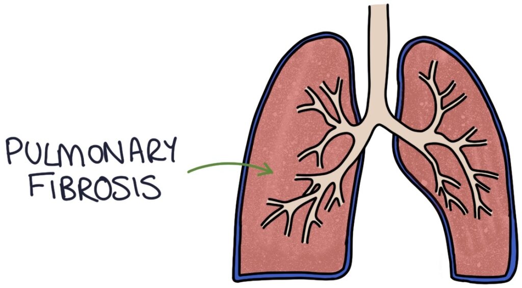 Systemic Sclerosis – Zero To Finals