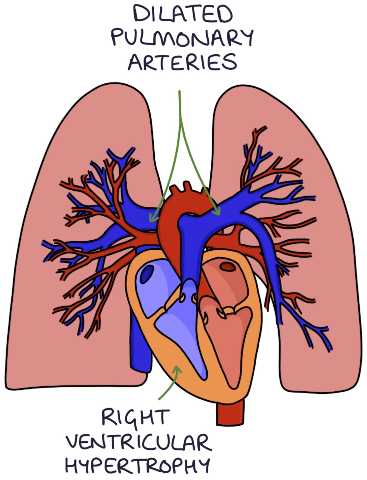 Pulmonary Hypertension – Zero To Finals