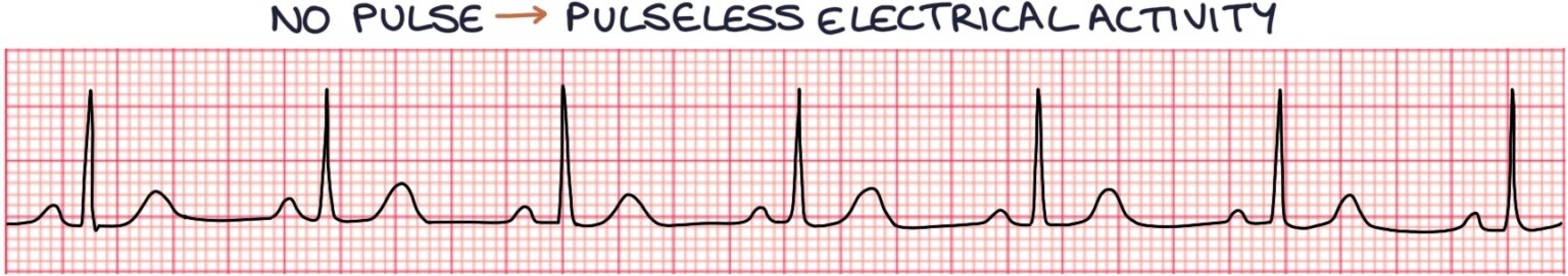 Arrhythmias – Zero To Finals