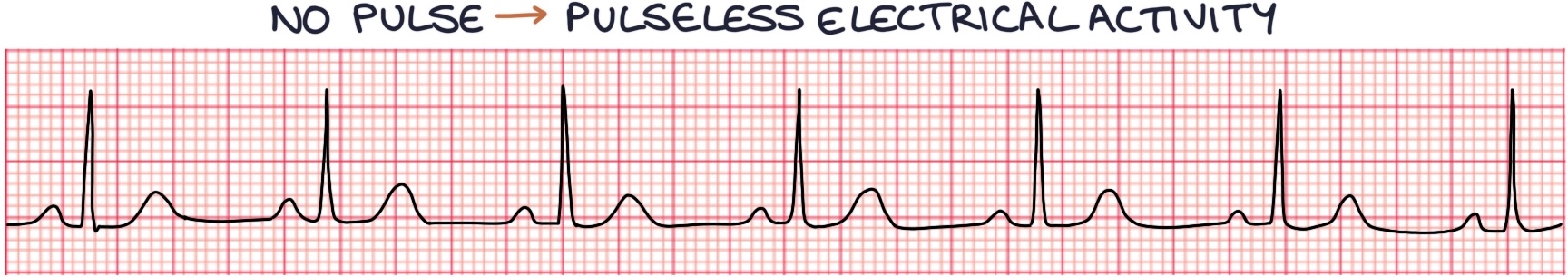 Arrhythmias – Zero To Finals
