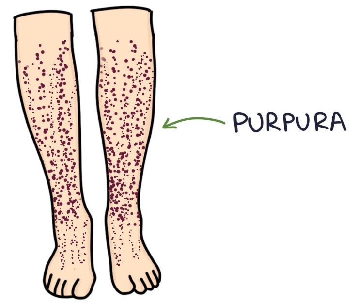 Thrombocytopenia – Zero To Finals