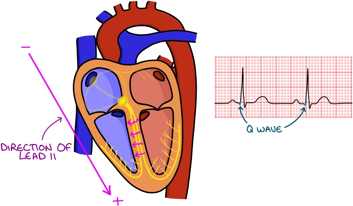 ECG Basics and Sinus Rhythm – Zero To Finals