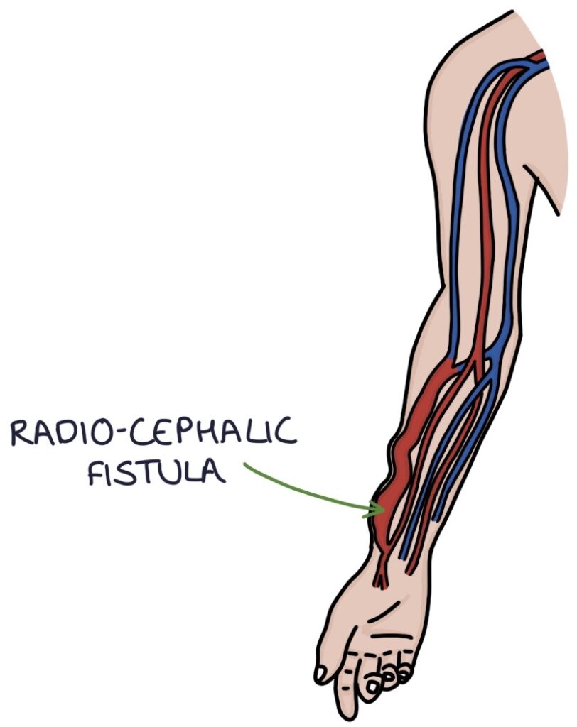 Dialysis – Zero To Finals