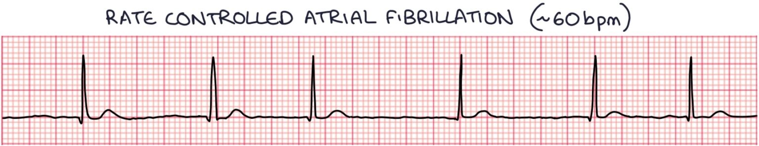 Atrial Fibrillation – Zero To Finals
