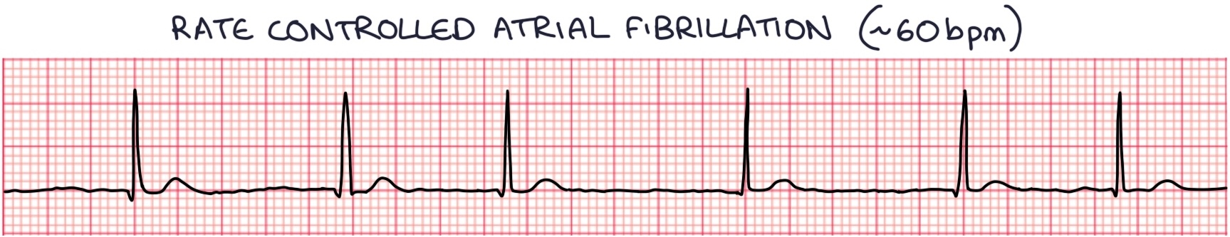 Atrial Fibrillation – Zero To Finals