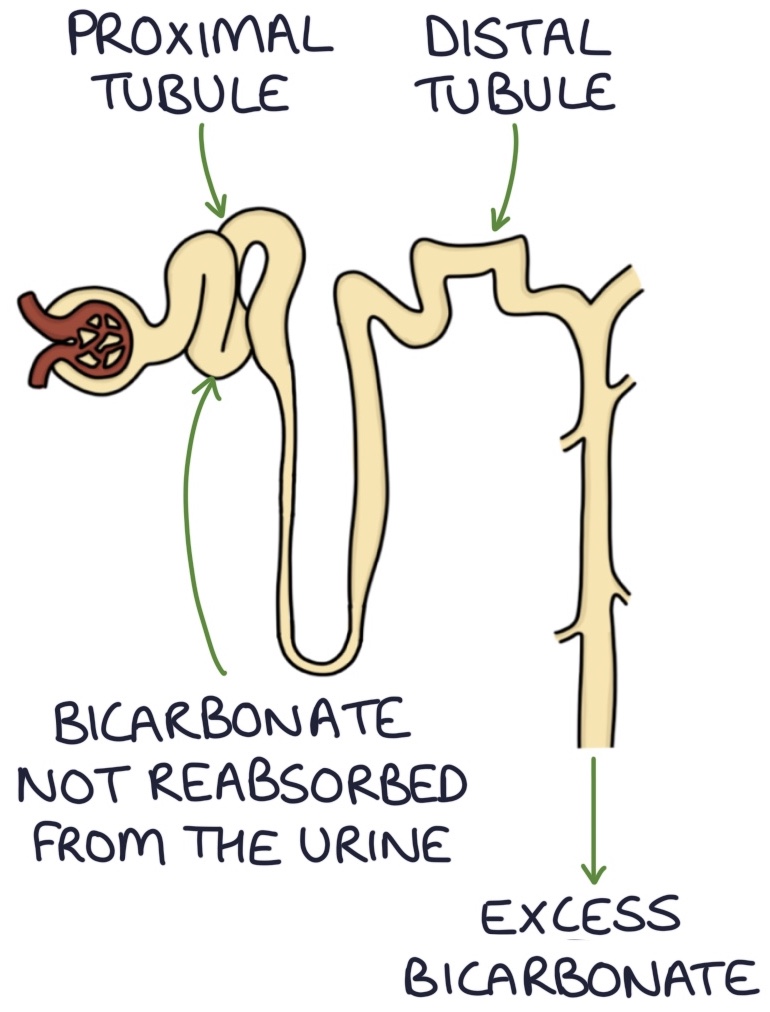 Renal Tubular Acidosis – Zero To Finals