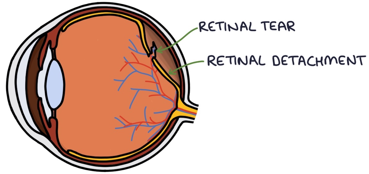Retinal Detachment – Zero To Finals