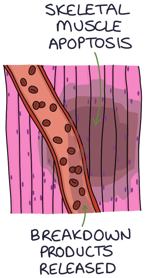 Rhabdomyolysis – Zero To Finals