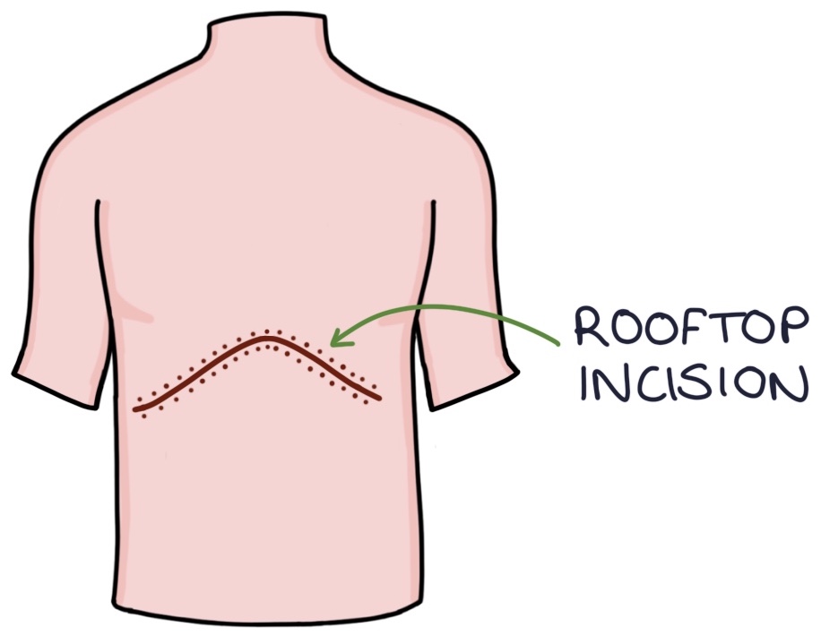 Liver Transplant – Zero To Finals