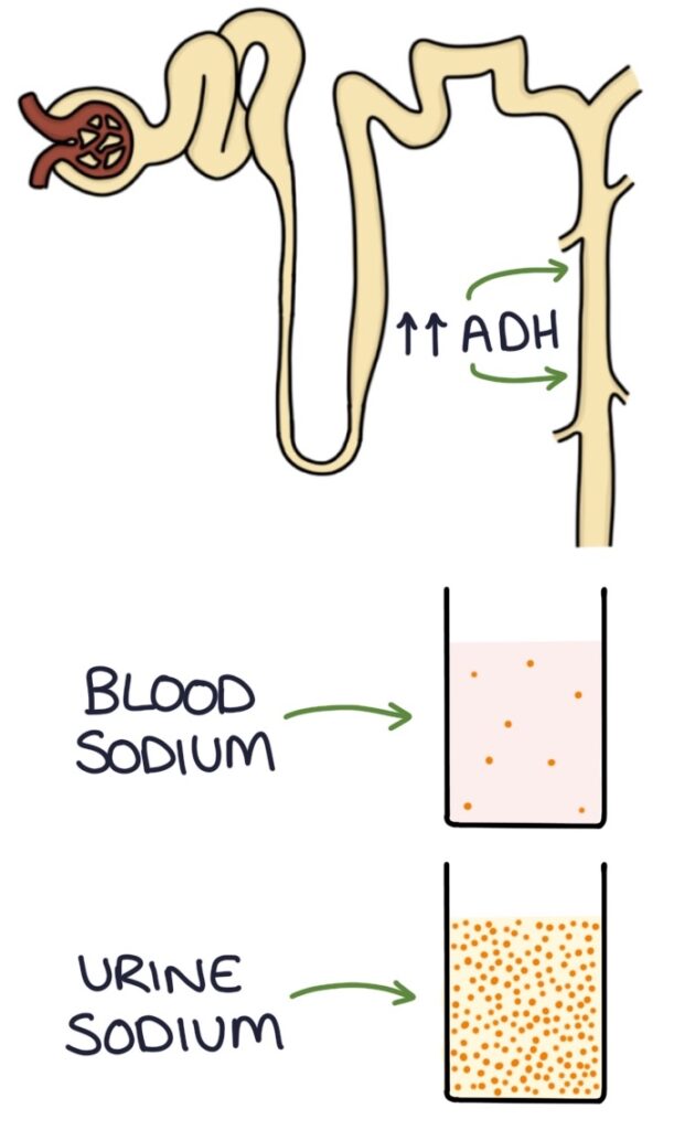Syndrome of Inappropriate Anti-Diuretic Hormone (SIADH) – Zero To Finals
