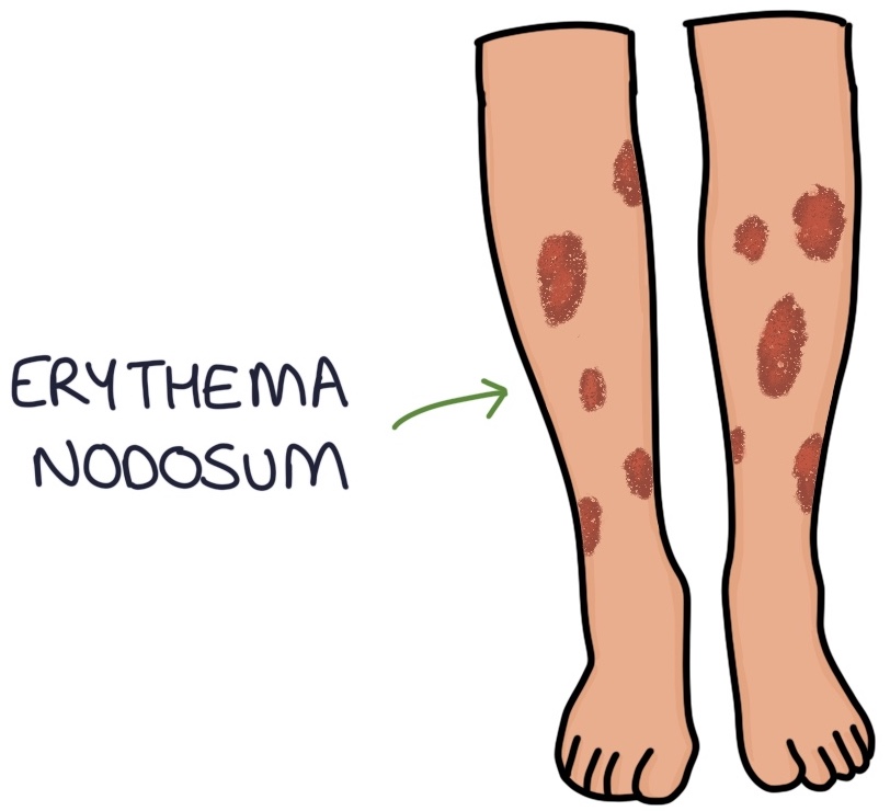 Sarcoidosis – Zero To Finals