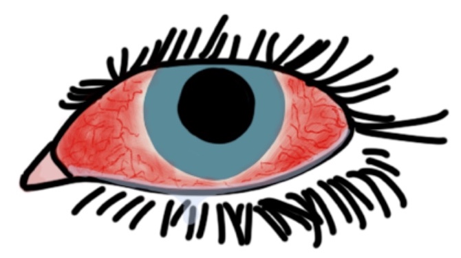 Scleritis – Zero To Finals