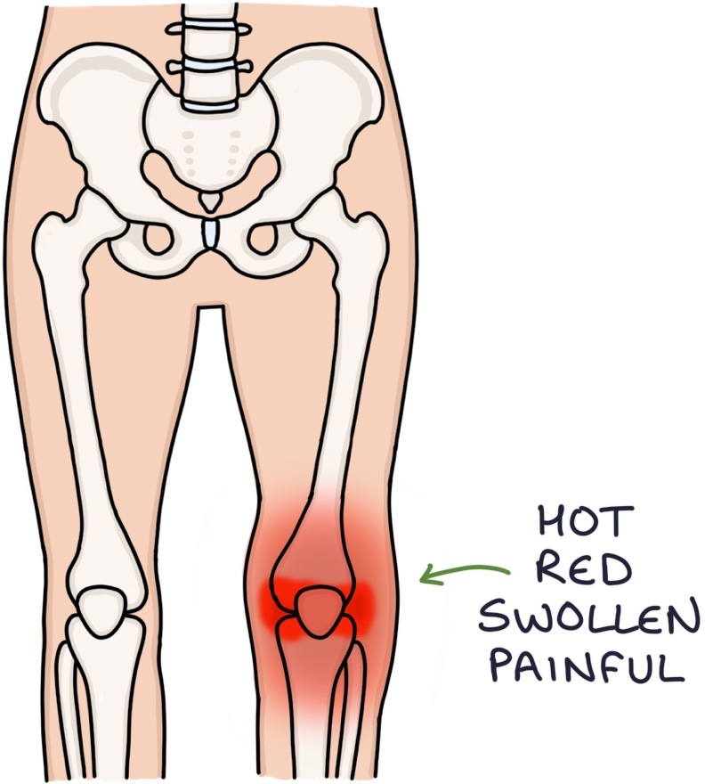 Septic Arthritis – Zero To Finals